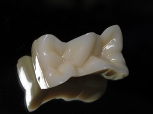 Inlays - Onlays en Odontologia ( Incrustaciones) - Clínica Dental Blay ...